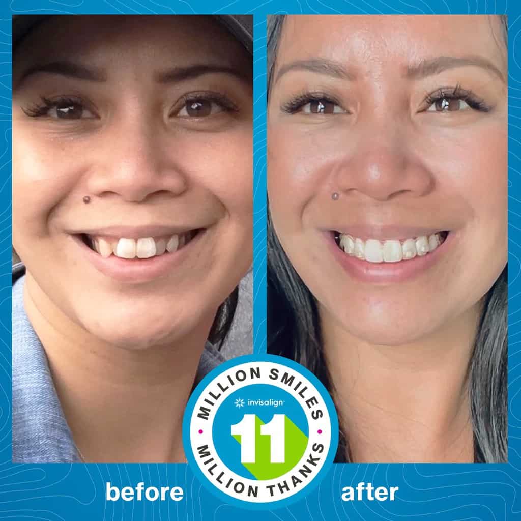 #1 Invisalign Cape Town | Clear Aligners | Platinum Certified