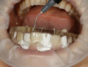 Injection Moulded Composite Veneers - OptiSmile Advanced Dentistry and ...