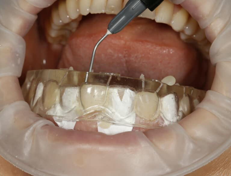 Injection Moulded Composite Veneers - OptiSmile Advanced Dentistry and ...